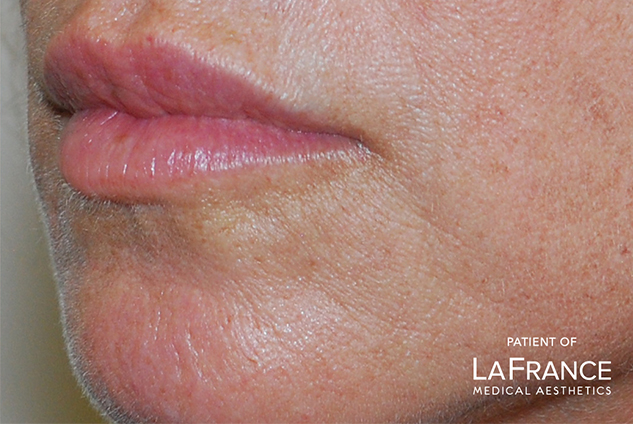 Injectable filler treatment_after - LaFrance - Medical Aesthetics ...