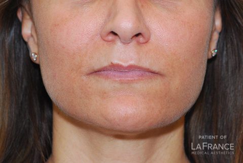 lafrance_injectable-fillers_before - LaFrance - Medical Aesthetics ...